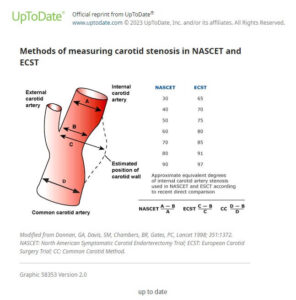 경동맥 협착증 평가 및 스텐트 급여기준, NASCET
