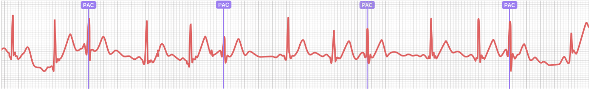 애플 워치, 갤럭시 워치 심전도 부정맥 보는 방법 - 심방조기수축(Premature Atrial Contraction, PAC)