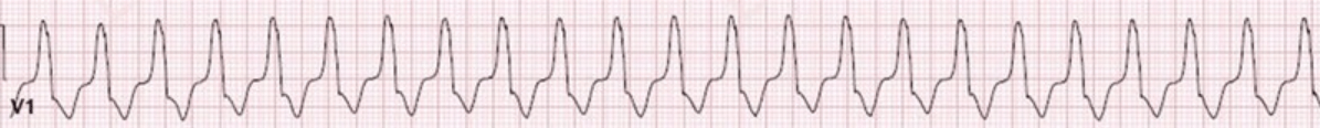 애플 워치, 갤럭시 워치 심전도 부정맥 보는 방법 - 심실조기수축(Premature Ventricular Contraction ...