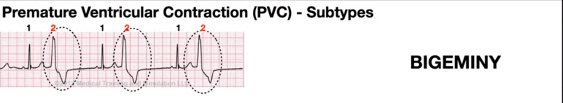 애플 워치, 갤럭시 워치 심전도 부정맥 보는 방법 - 심실조기수축(Premature Ventricular Contraction ...