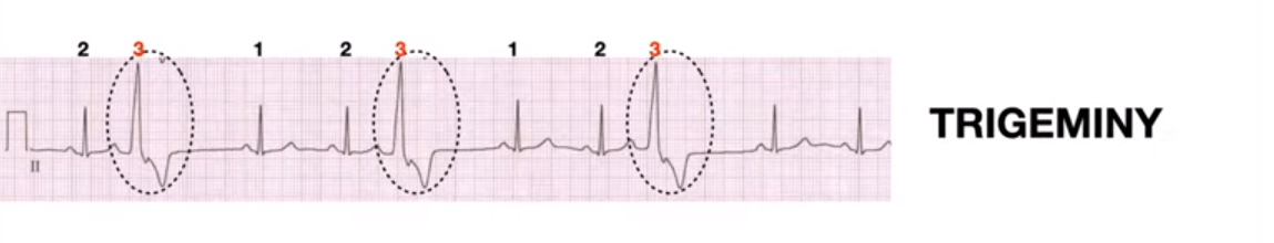 애플 워치, 갤럭시 워치 심전도 부정맥 보는 방법 - 심실조기수축(Premature Ventricular Contraction ...