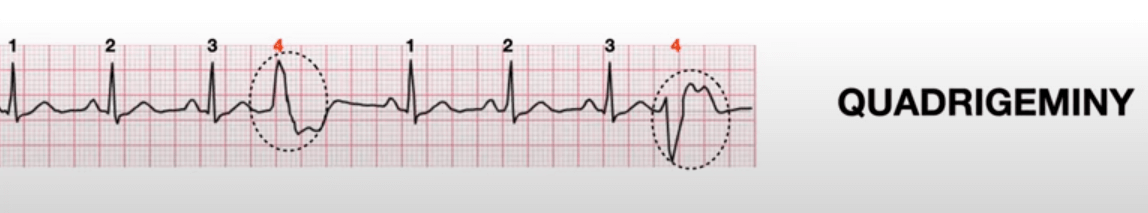 애플 워치, 갤럭시 워치 심전도 부정맥 보는 방법 - 심실조기수축(Premature Ventricular Contraction ...