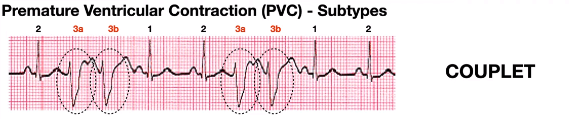 애플 워치, 갤럭시 워치 심전도 부정맥 보는 방법 - 심실조기수축(Premature Ventricular Contraction ...